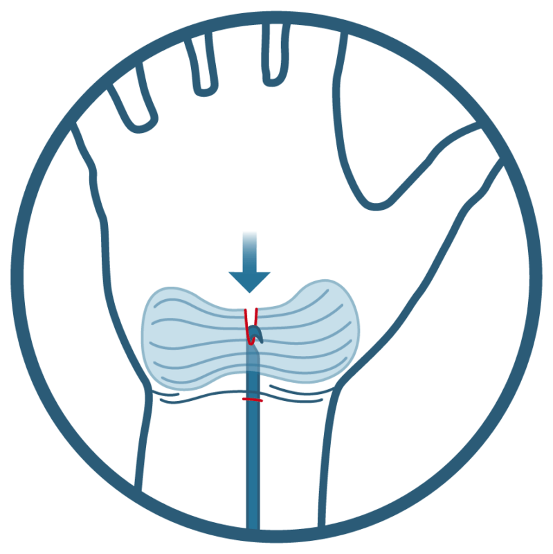 PUC | Karpaltunnel Op - Schonende Ultraschallgezielte Spaltung