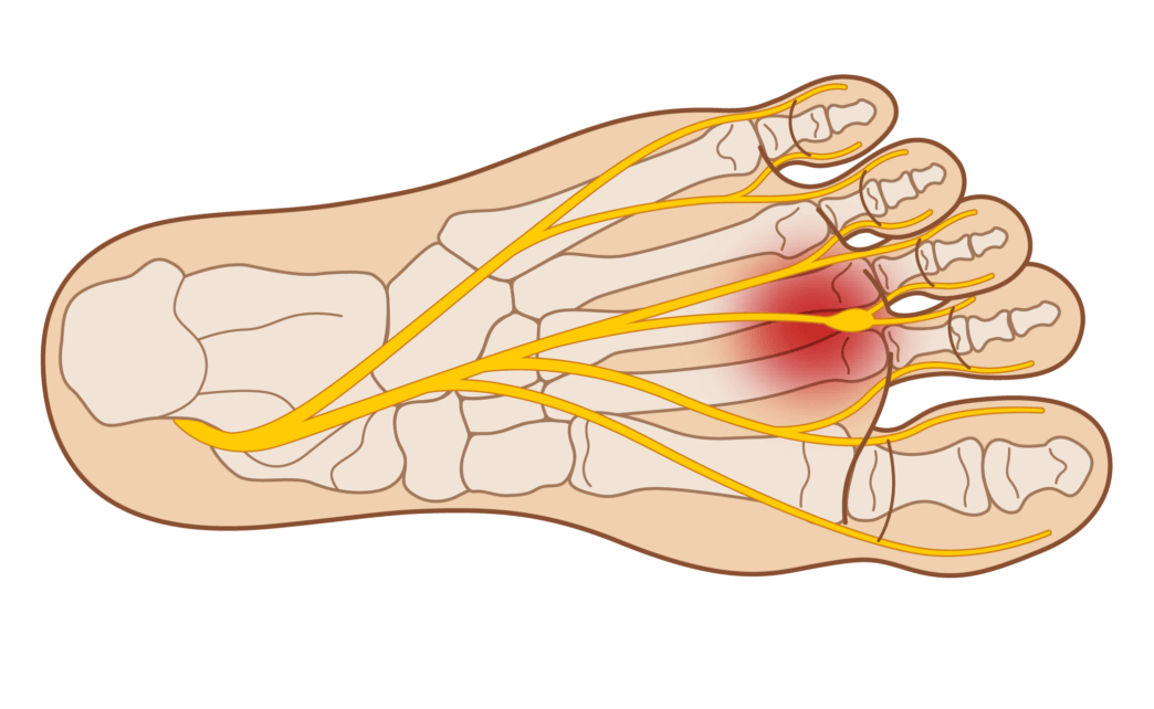 PUC | Morton Neurom | Diagnose und Therapie mittels HD-Ultraschall