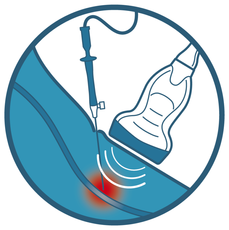 PUC | Morton Neurom | Diagnose und Therapie mittels HD-Ultraschall